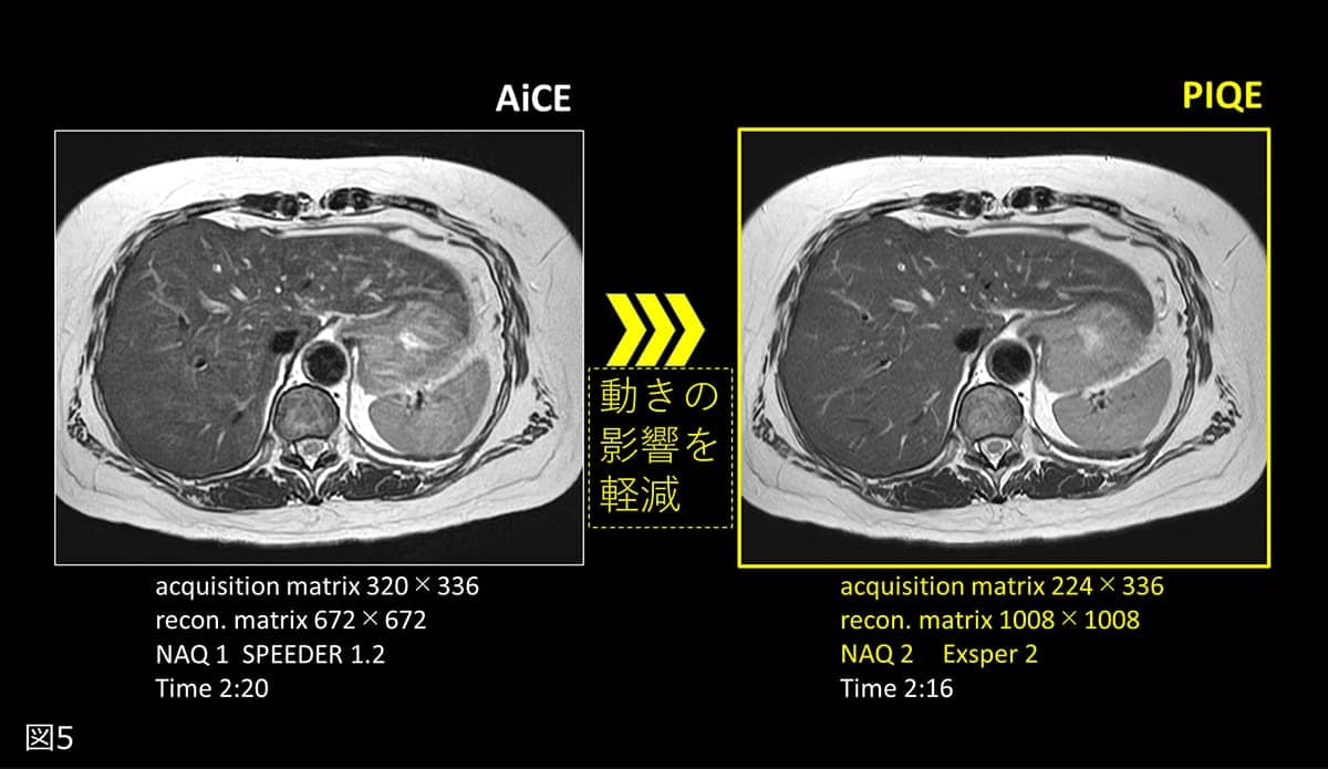 SoftwareVer.9.0がもたらした新たなMRI検査について｜日本医科大学付属病院様｜MRI｜導入事例｜epicus CLUB｜キヤノン ...